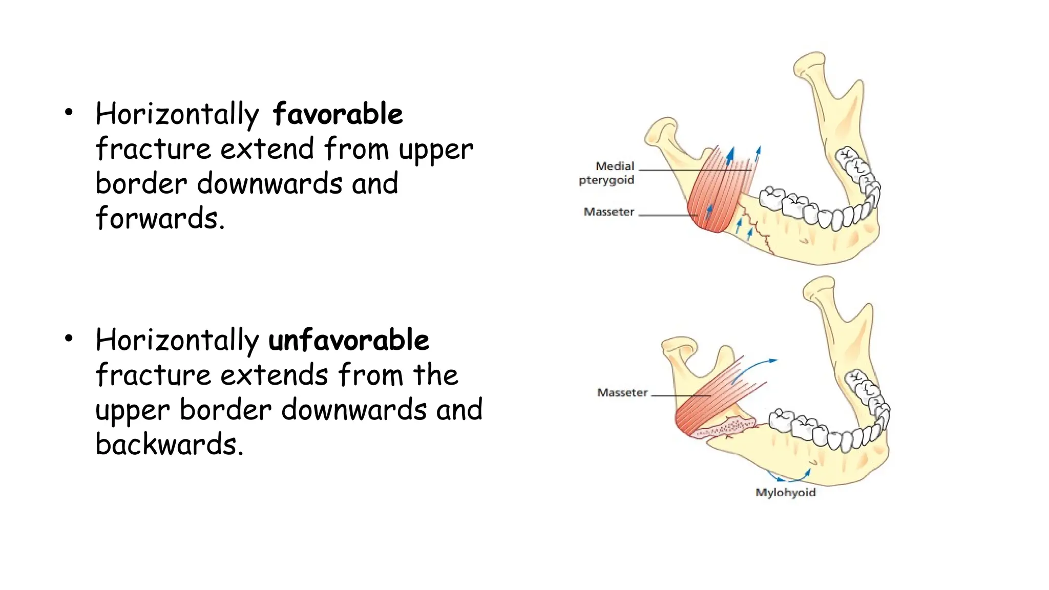 Mandibular fractures and their management | PPTX
