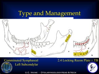 Mandible Fracture 01 31 08 | PPT
