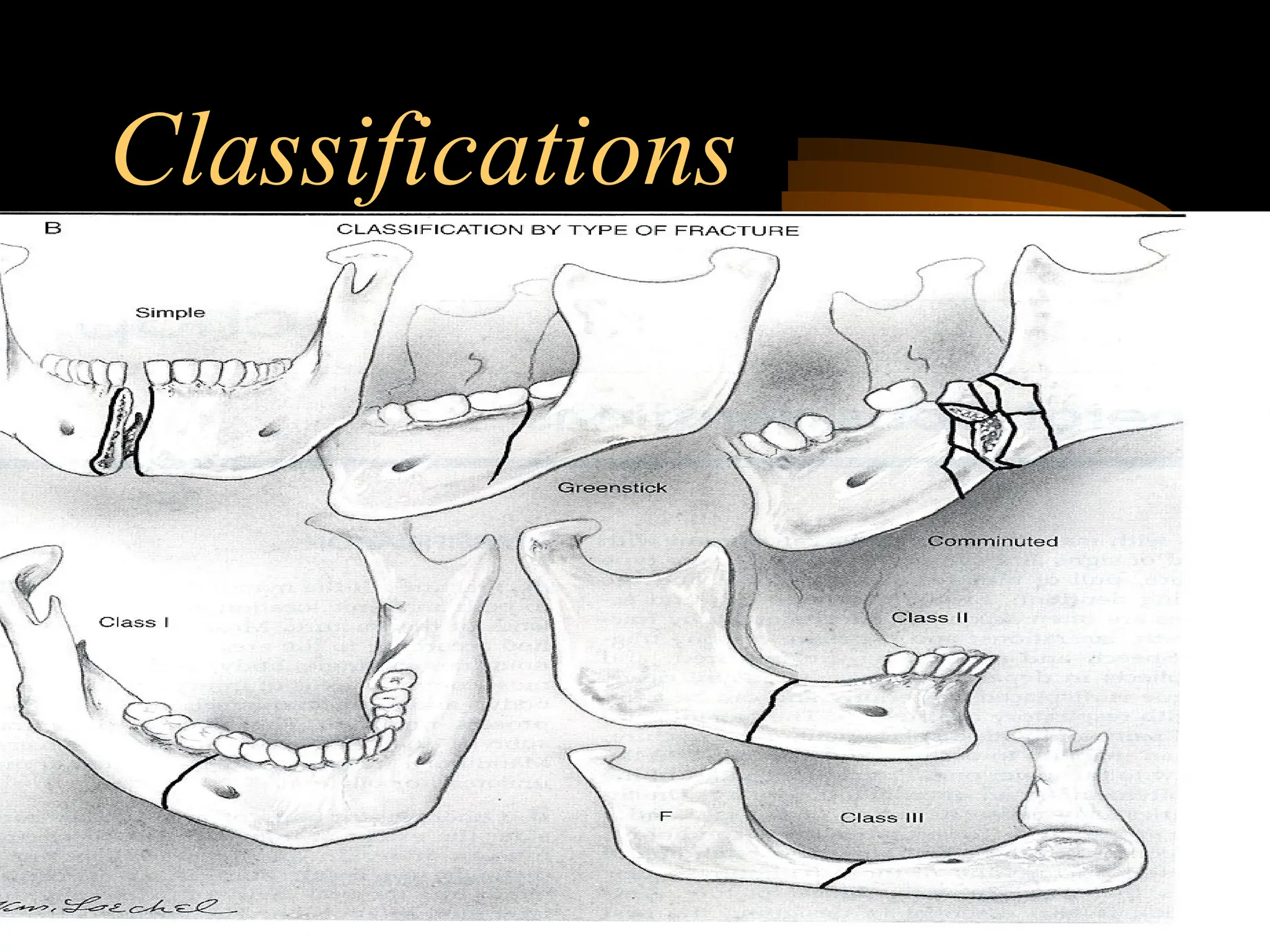 Mandible fracture signs and symptoms ppt | PPT