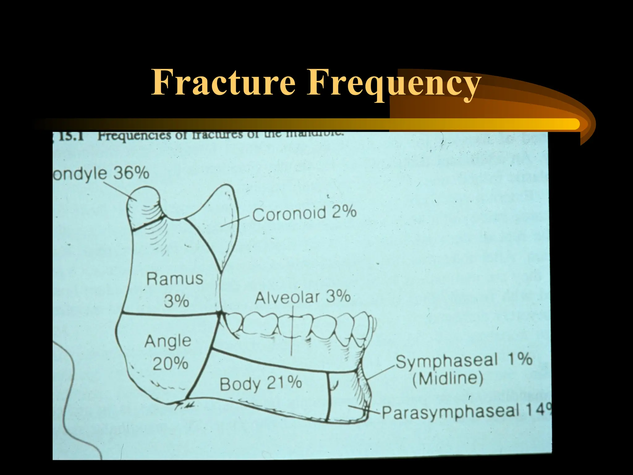 Mandible fracture signs and symptoms ppt | PPT