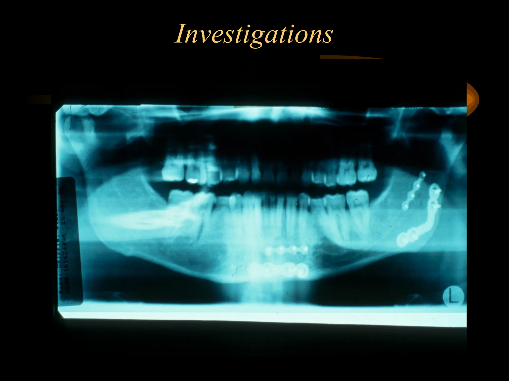Mandible fracture signs and symptoms ppt | PPT