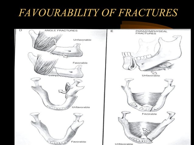 Mandible fracture signs and symptoms ppt | PPT