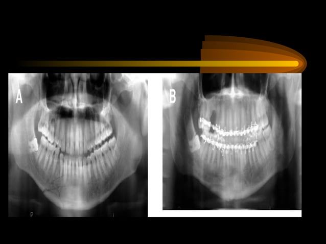 Mandible fracture signs and symptoms ppt | PPT
