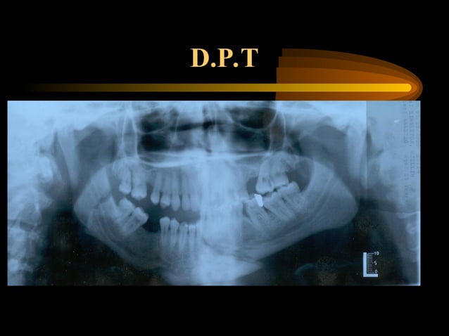Mandible fracture signs and symptoms ppt | PPT