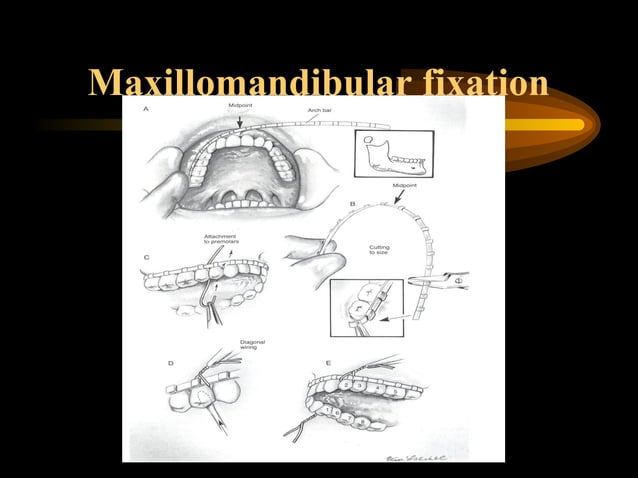 Mandible fracture signs and symptoms ppt | PPT