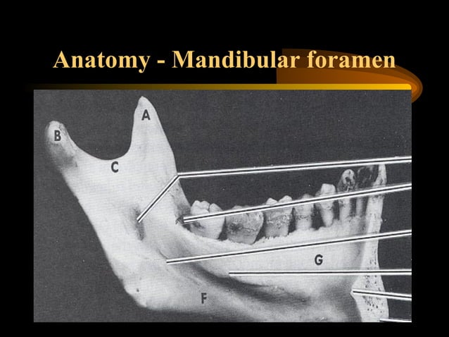 Mandible fracture signs and symptoms ppt | PPT