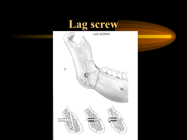 Mandible fracture signs and symptoms ppt | PPT