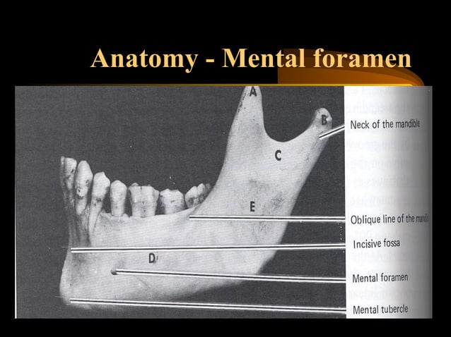 Mandible fracture signs and symptoms ppt | PPT