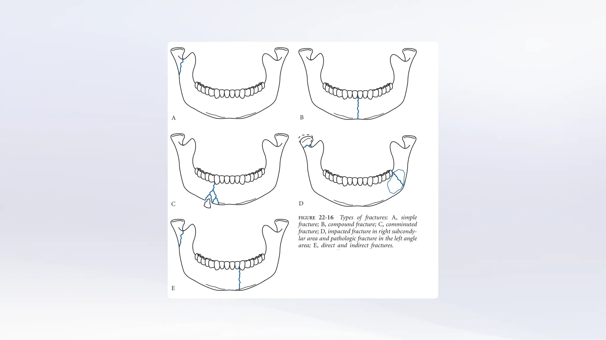 Mandible-Lower-Jaw-Fracture (1).pdf | Death, Injury, or Military ...