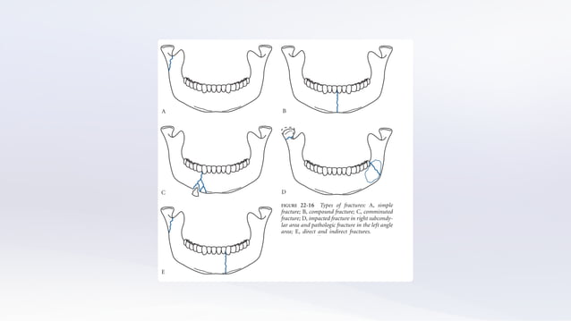 Mandible-Lower-Jaw-Fracture (1).pdf