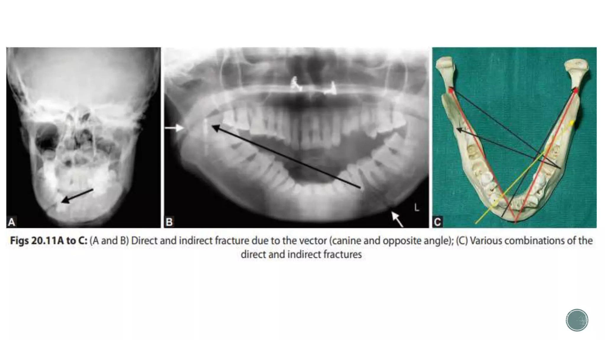 Mandibular Fractures | PPTX