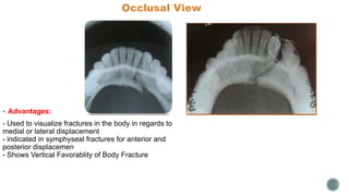 Mandibular Fractures | PPTX