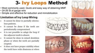Mandibular Fractures | PPTX