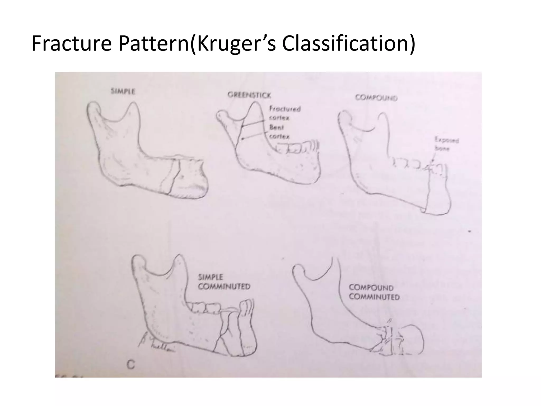Mandible fracture | PPTX