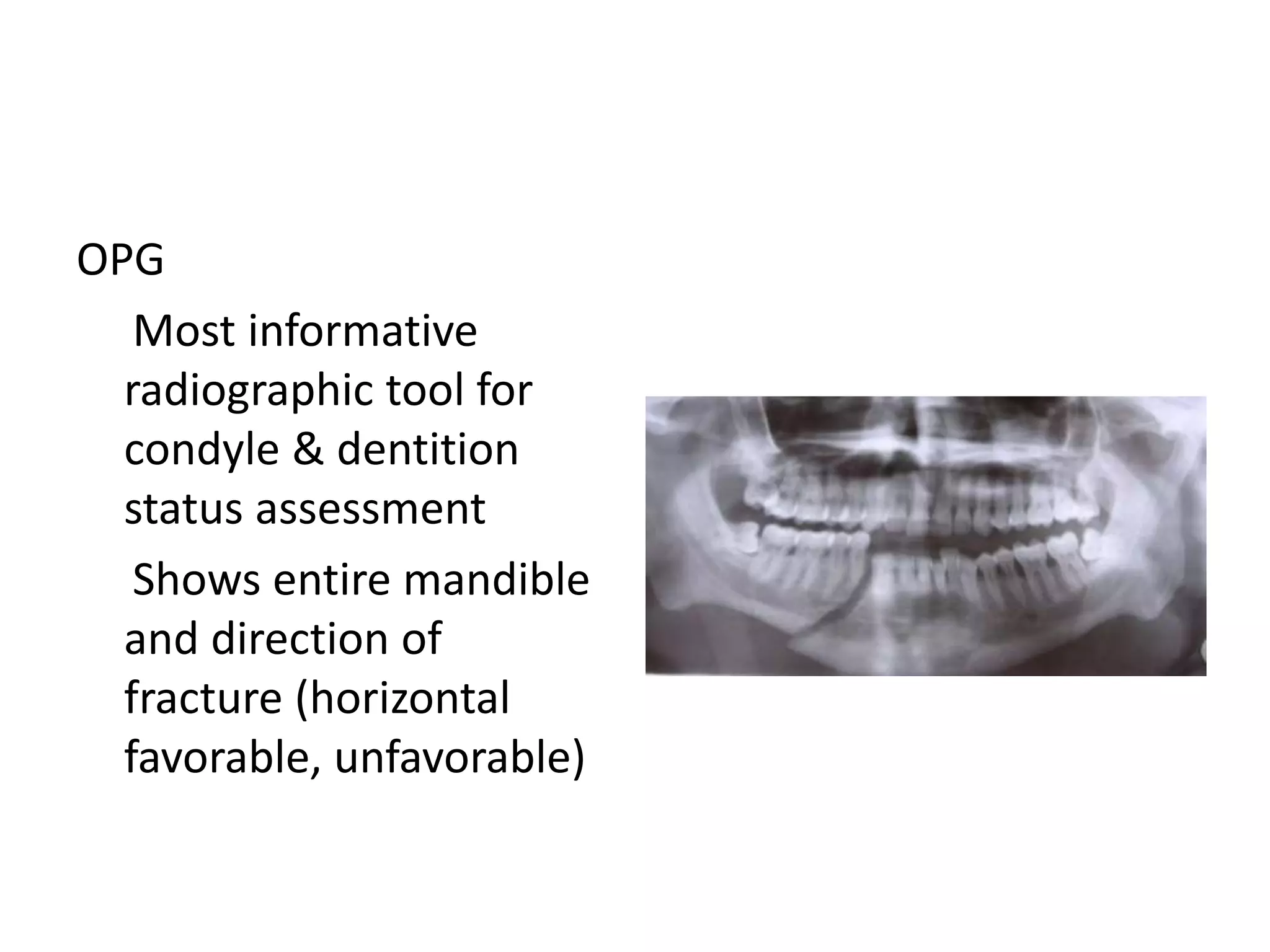 Mandible fracture | PPTX