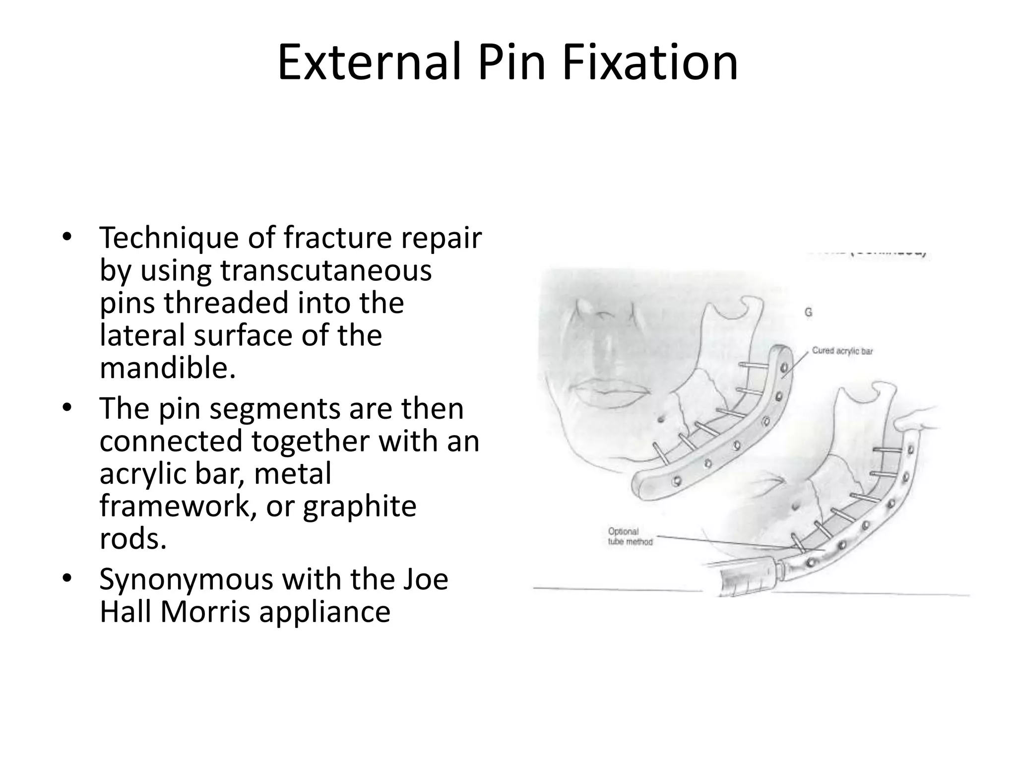 Mandible fracture | PPTX