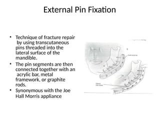 mandiblefracture Mandibular fracture.pptx