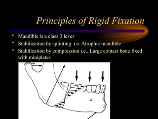 Mandible Fractures and medical management | PPTX