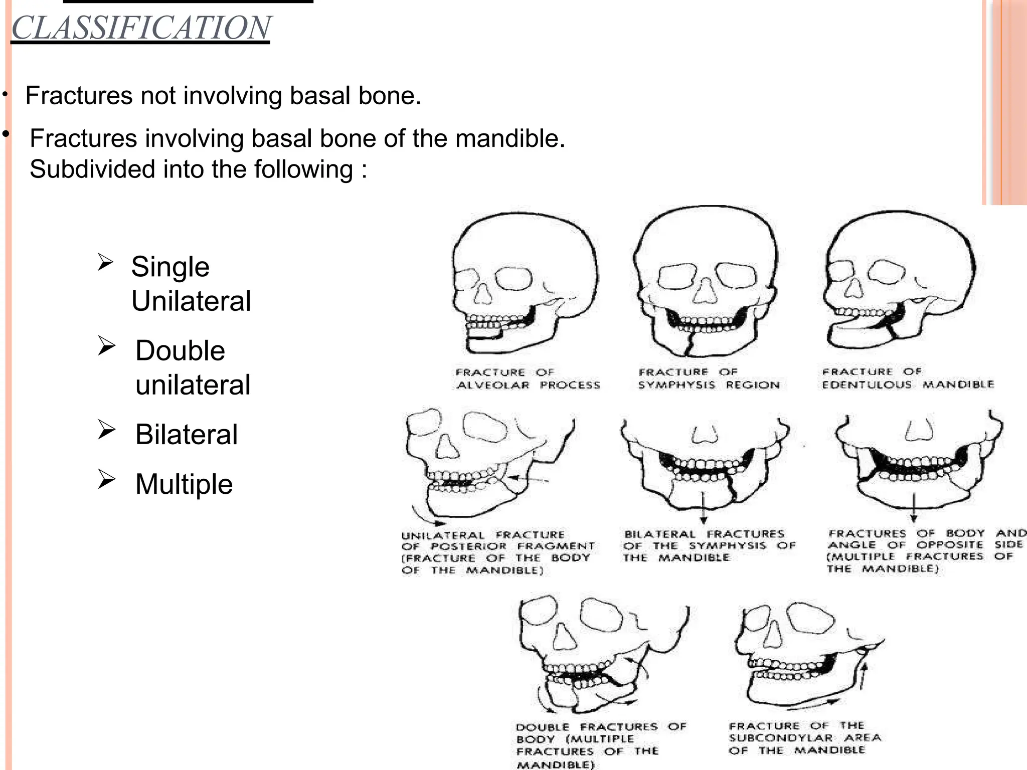 Mandible fractures Part 1 of oral surgery | PPTX