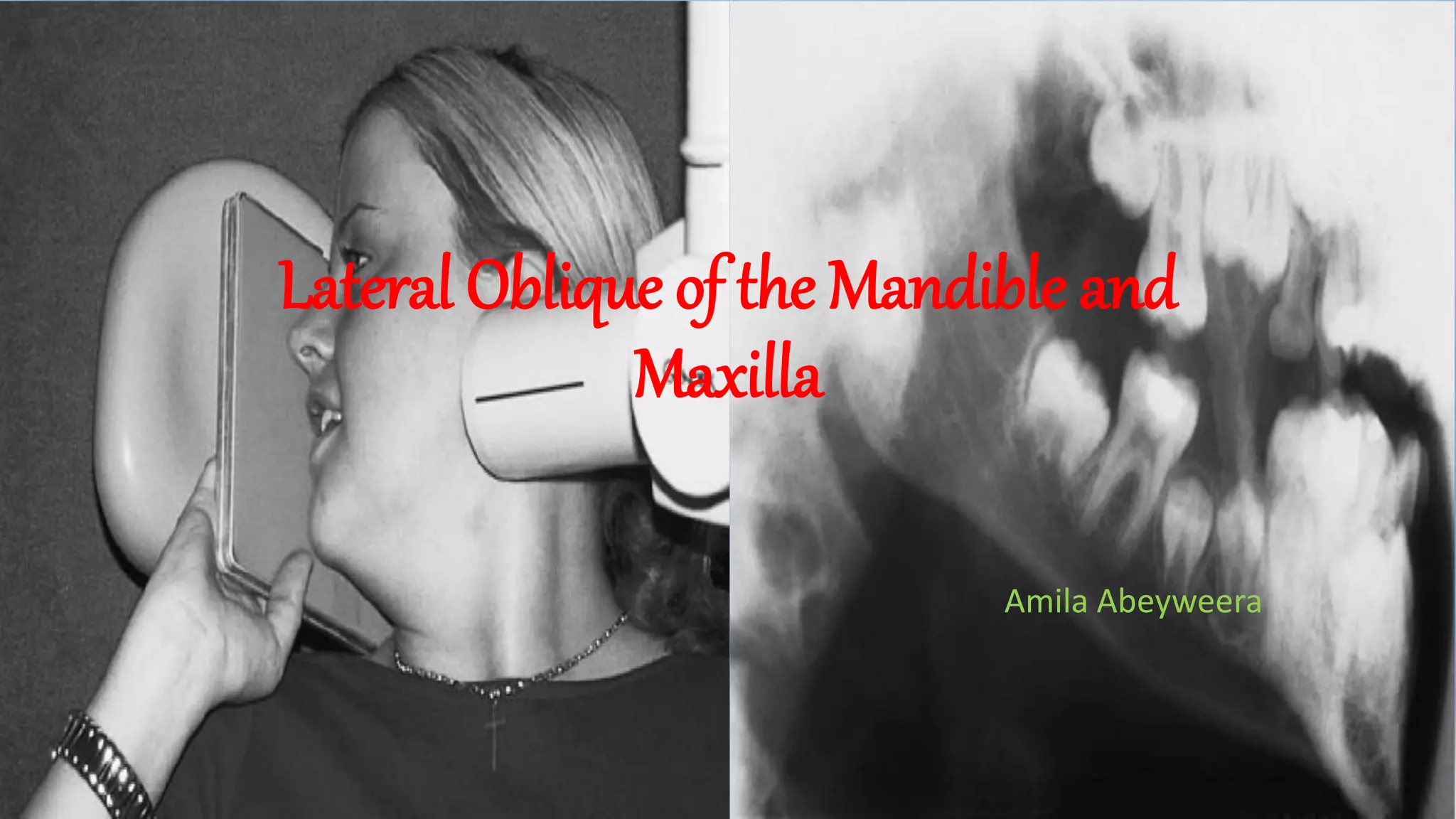 Mandible lateral oblique | PPTX