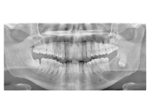 Diagnostic Imaging of Mandible & Maxilla | PPT | Dental Health ...