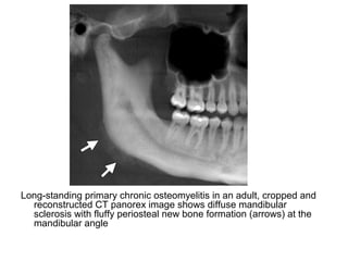 Mandible Fracture Panorex