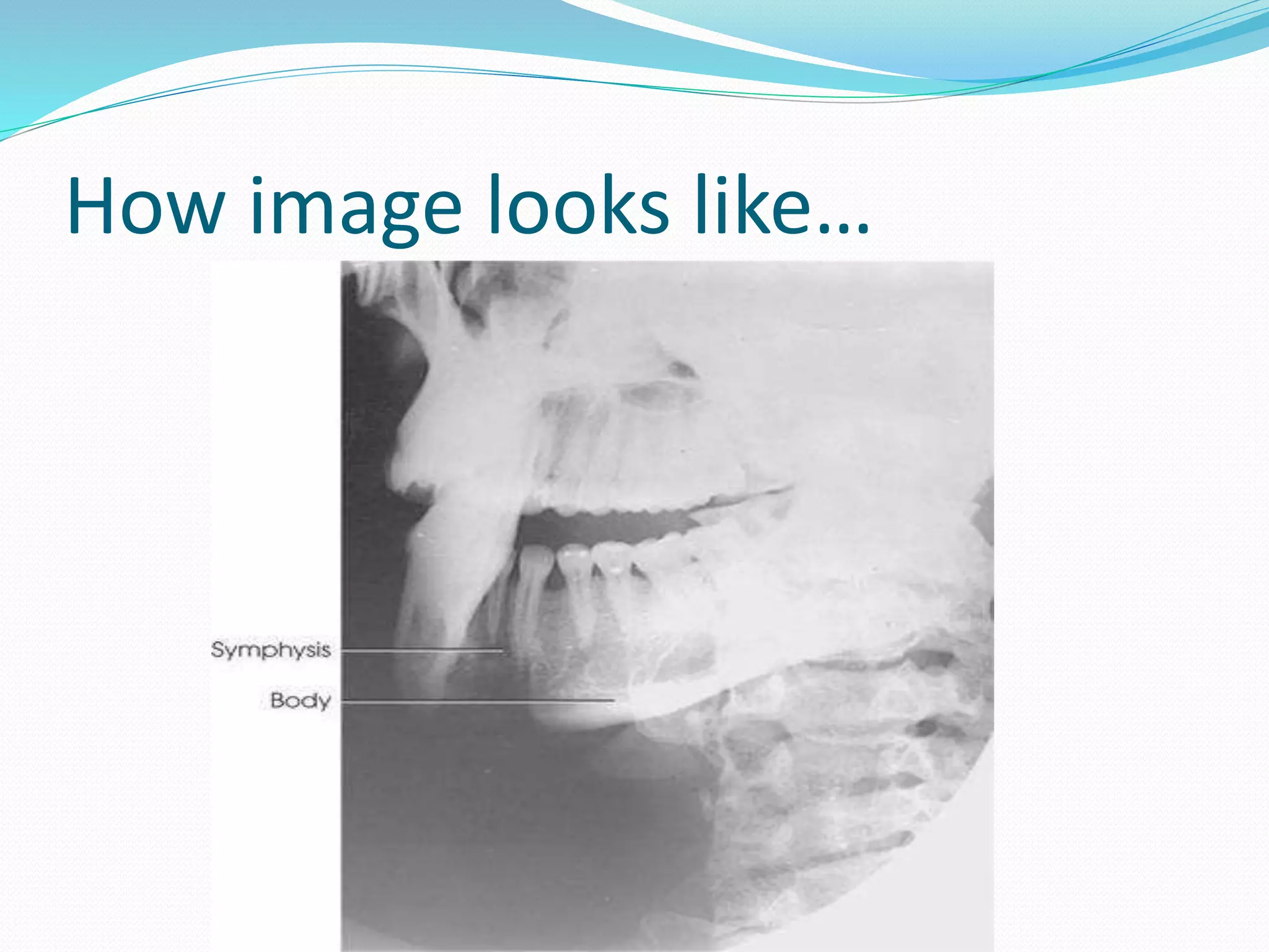 Mandible and maxilla oblique radiography | PPTX