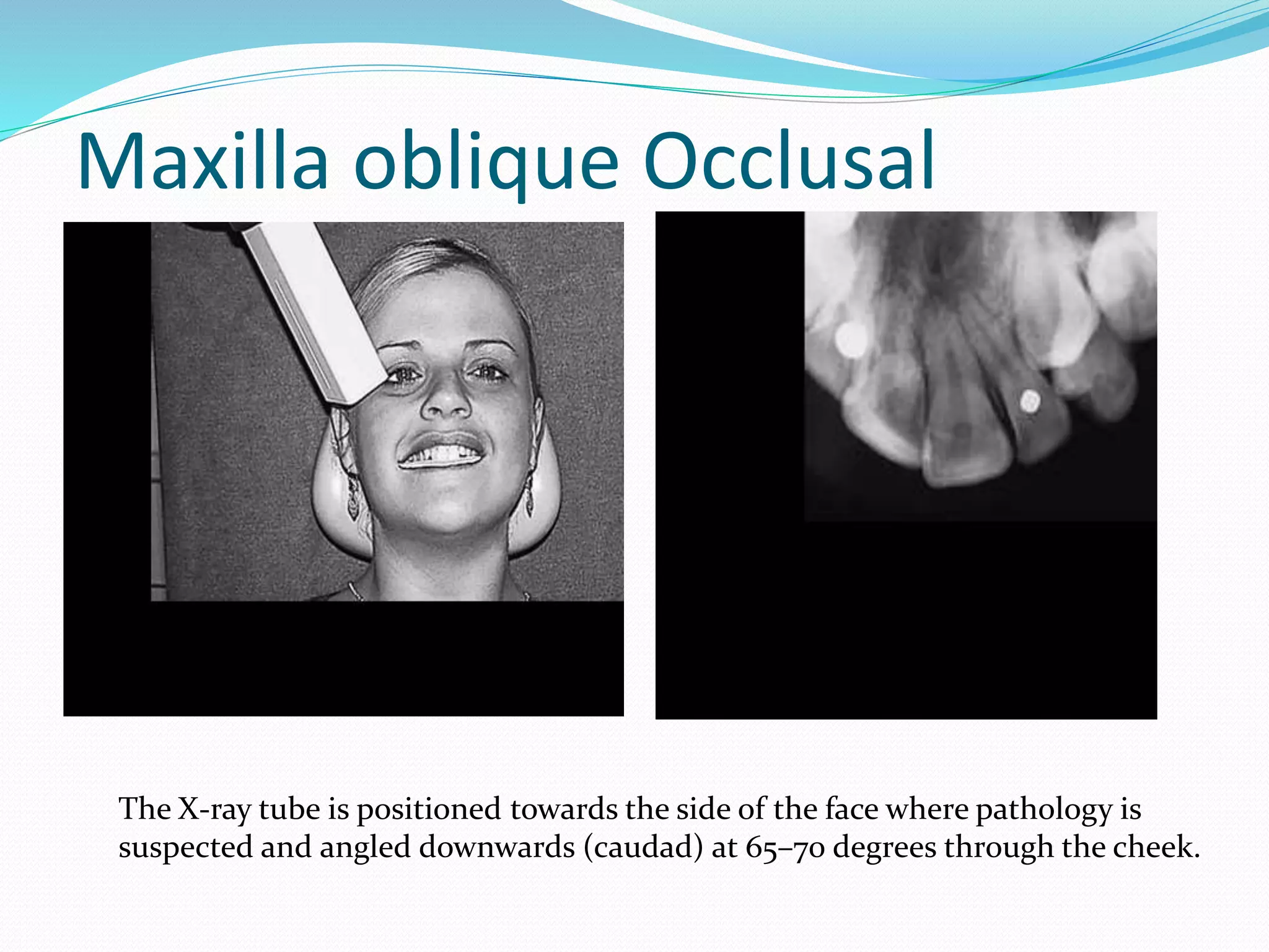 Mandible and maxilla oblique radiography | PPTX