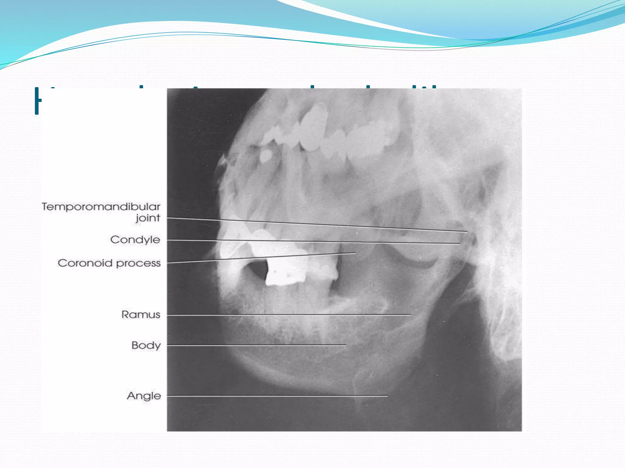 Mandible and maxilla oblique radiography | PPTX