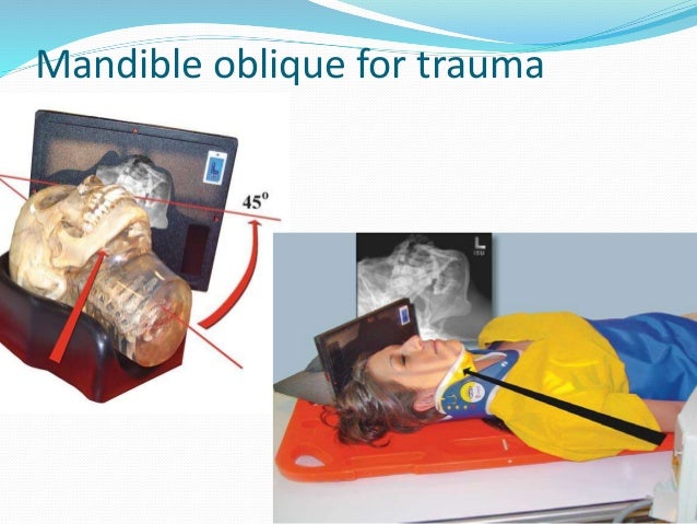 Mandible and maxilla oblique radiography