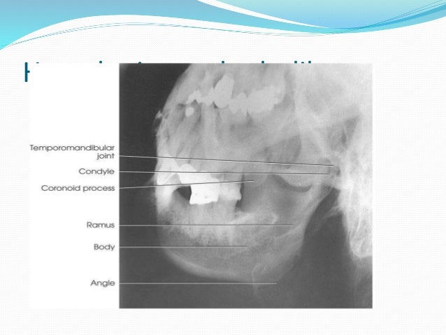 Mandible and maxilla oblique radiography