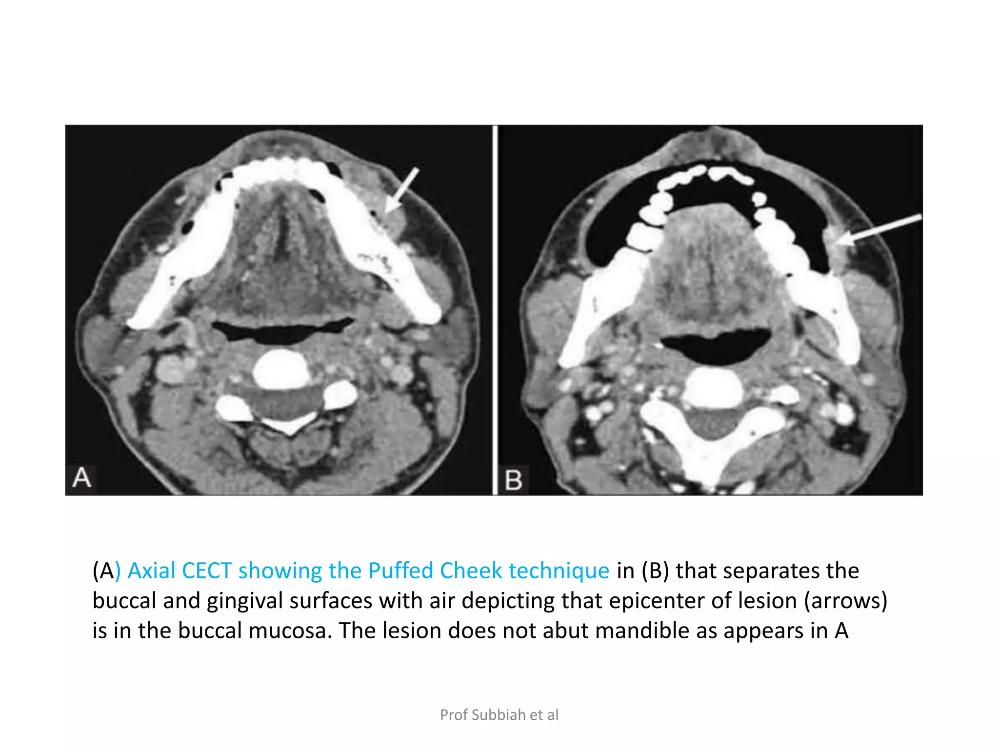 MANAGING MANDIBLE IN ORAL CAVITY CANCERS ppt(1).pptx