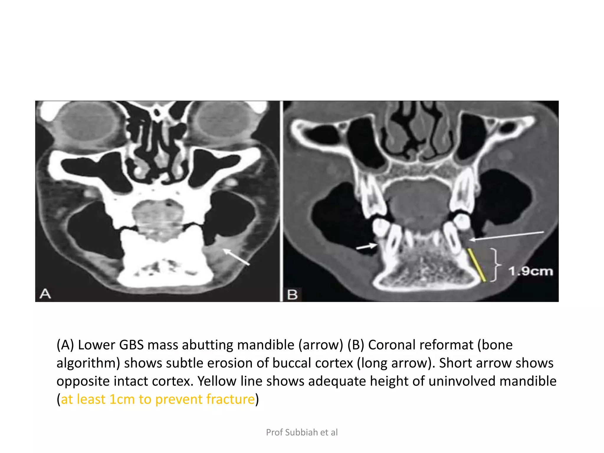 MANAGING MANDIBLE IN ORAL CAVITY CANCERS ppt(1).pptx