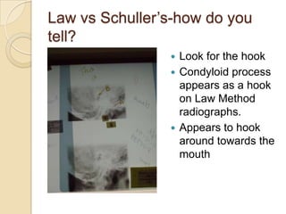 Mandible, T M J | PPTX