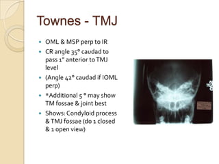 Mandible, T M J | PPTX
