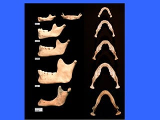 Mandibula dhe Maksila. Document power point | PPT