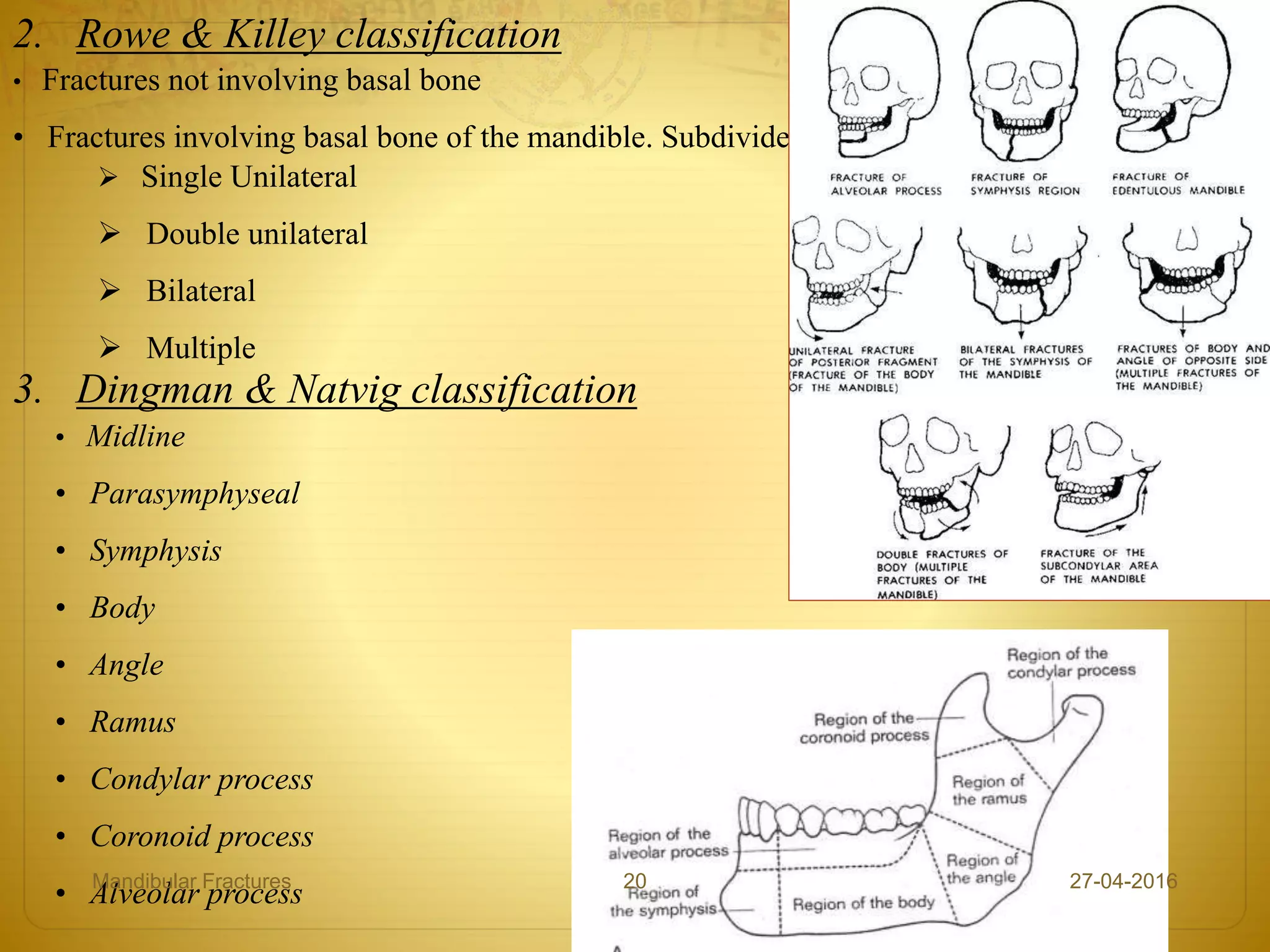Mandibular fractures | PPTX