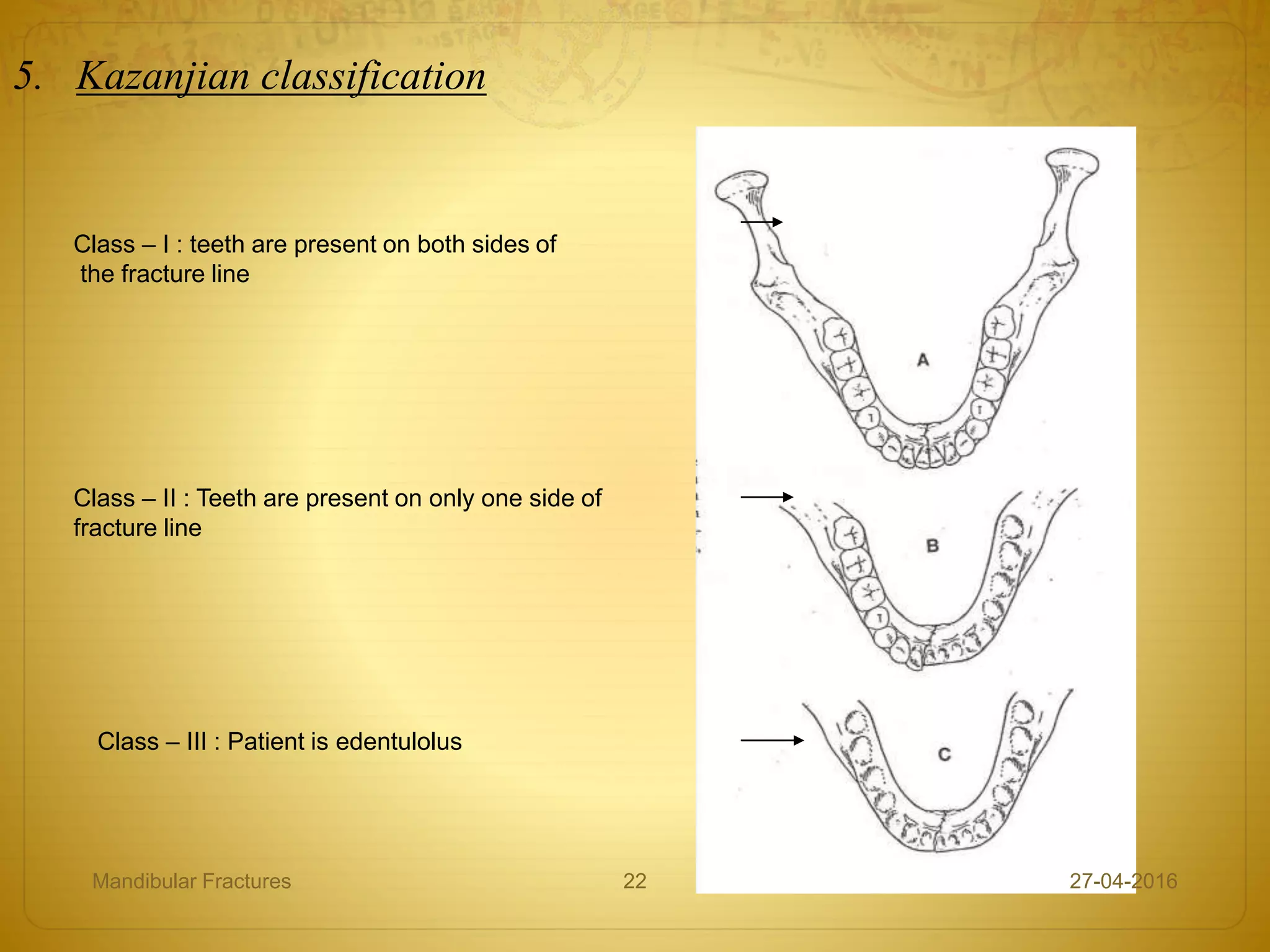 Mandibular fractures | PPTX