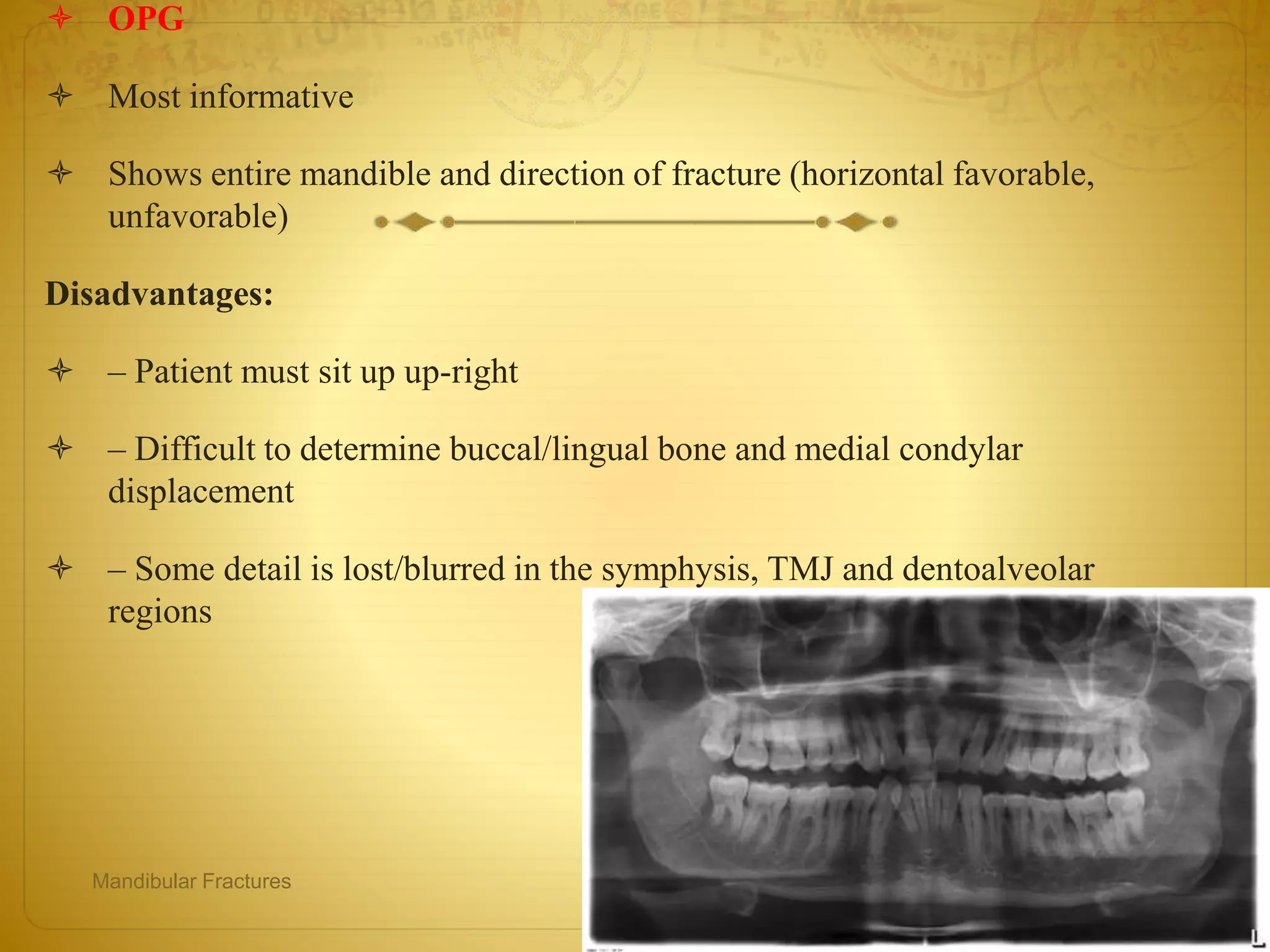 Mandibular fractures | PPTX
