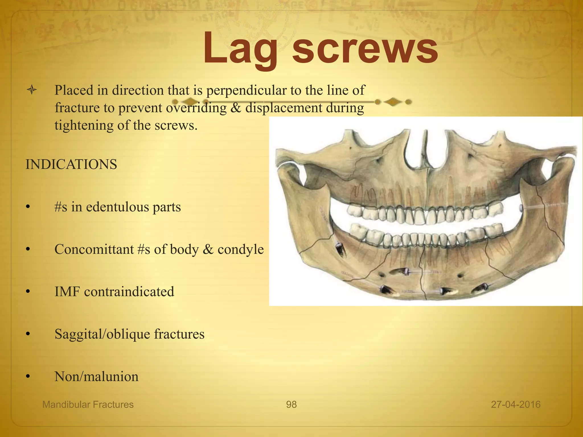 Mandibular fractures | PPTX