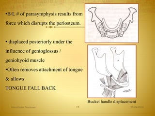 Bucket Handle Fracture