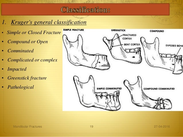 Mandibular fractures