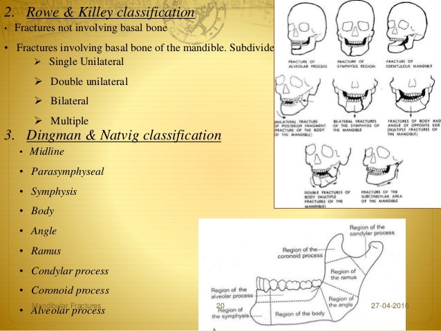 Mandibular fractures