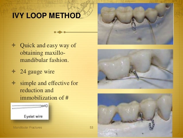 Mandibular fractures