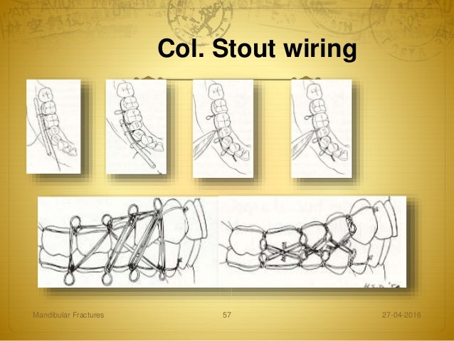 Mandibular fractures