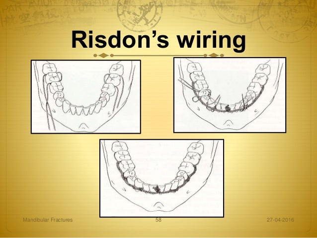 Mandibular fractures