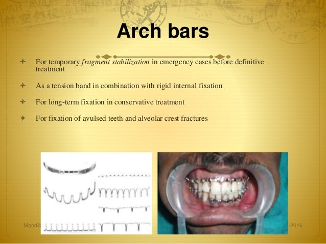 Mandibular fractures