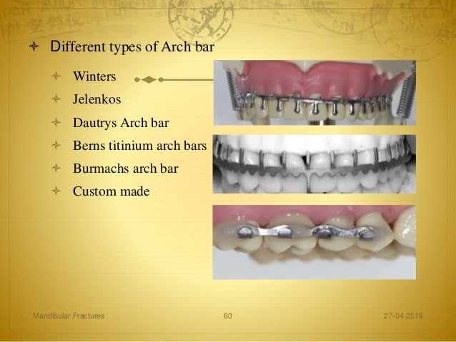 Mandibular fractures