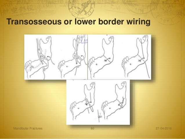 Mandibular fractures