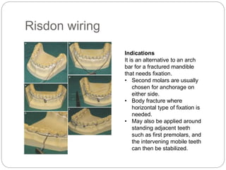 Mandibular-#-2.pptx